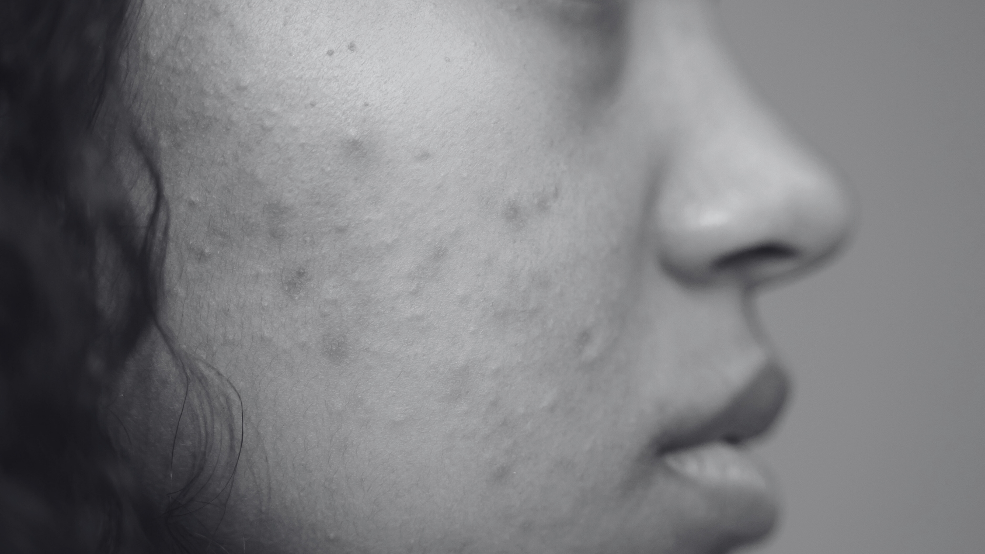 What are the root causes of acne? - KOZA Skin Clinic