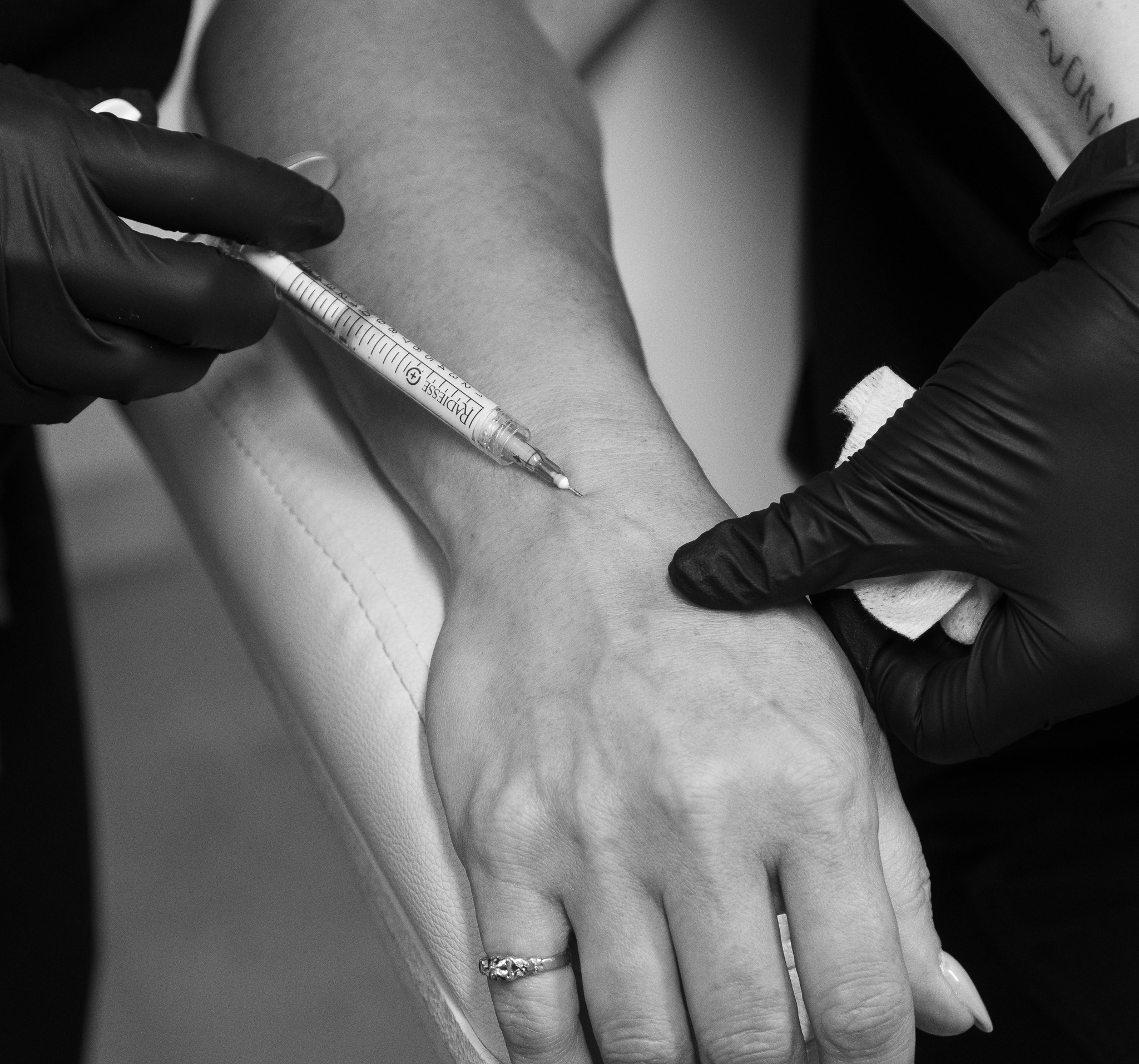 Rewind the Clock on Aging Hands with Radiesse - KOZA Skin Clinic